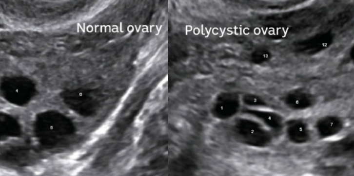 Vezoret policistike si shkaktare të infertilitetit